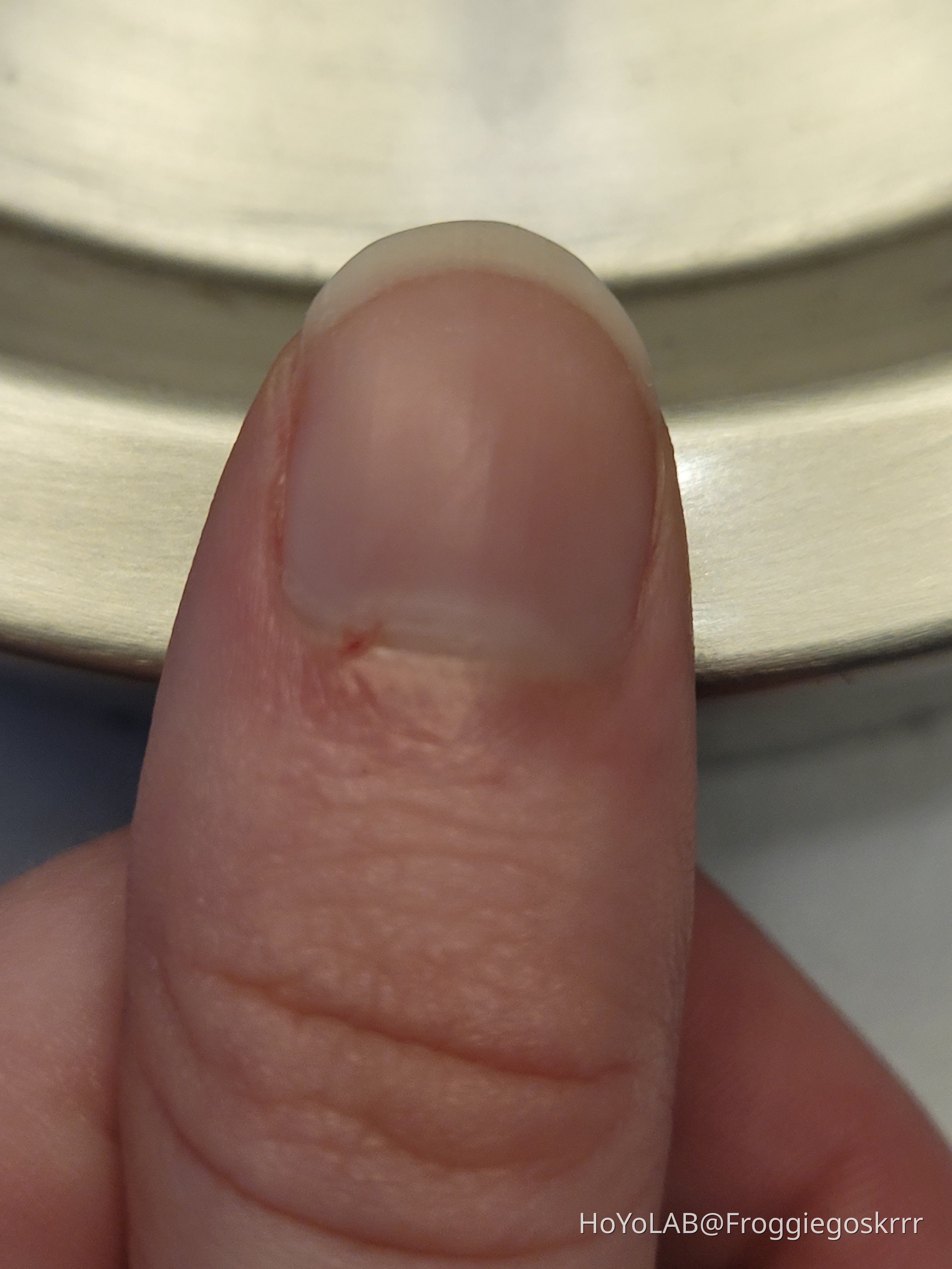 I'm bleeding out of my fingernail🥲 | HoYoLAB